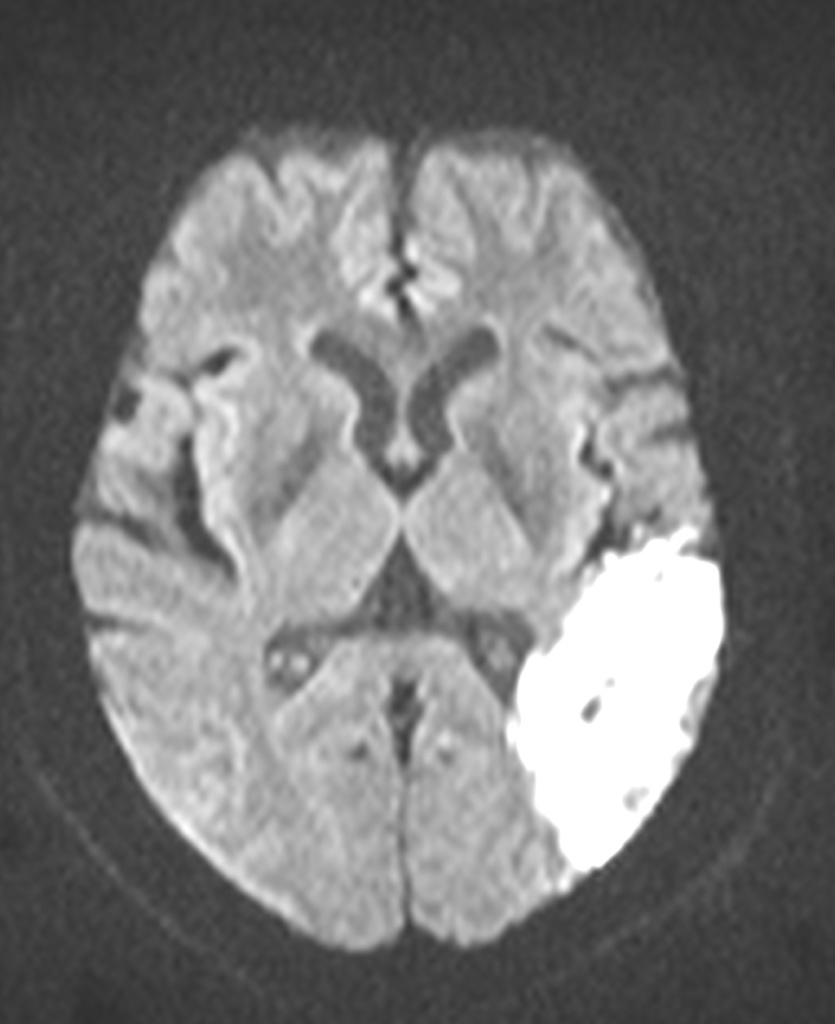 SECUENCIA DEL INFARTO (DWI) - Centro de Diagnóstico por Imágenes Linda ...
