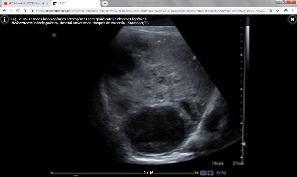 Abscesos Hepáticos. Diagnóstico Radiológico. - Centro de Diagnóstico ...