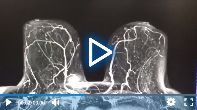 RM dinámica de mama (normal). - Centro de Diagnóstico por Imágenes ...