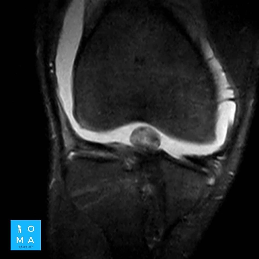 RM en la rodilla operada - Centro de Diagnóstico por Imágenes Linda Vista