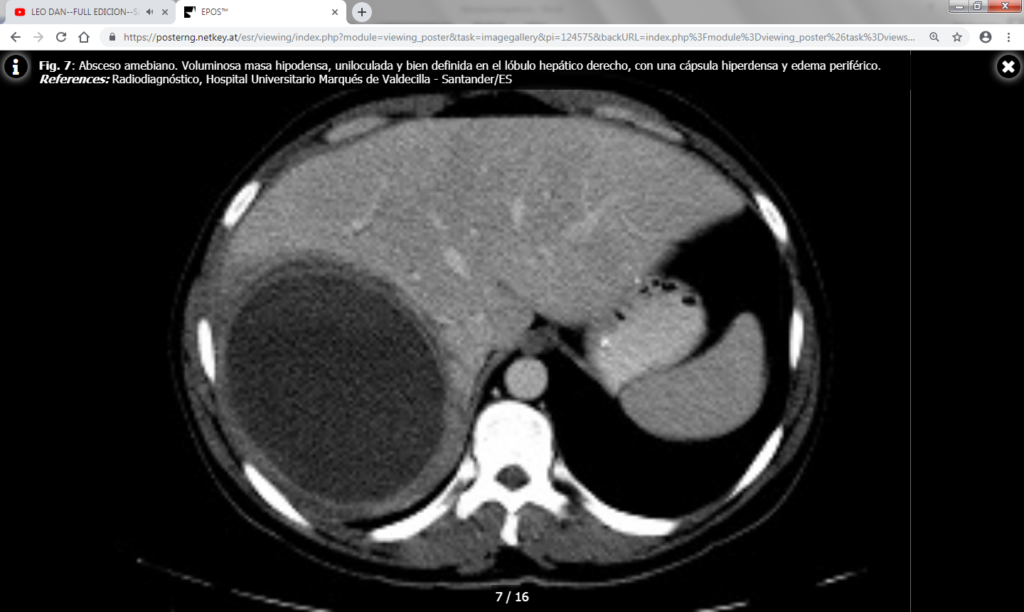 Abscesos Hepáticos. Diagnóstico Radiológico. - Centro de Diagnóstico ...