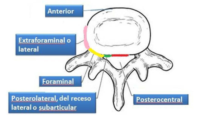 NOMENCLATURA DE LA PATOLOGIA DISCAL POR RM - Centro de Diagnóstico por ...